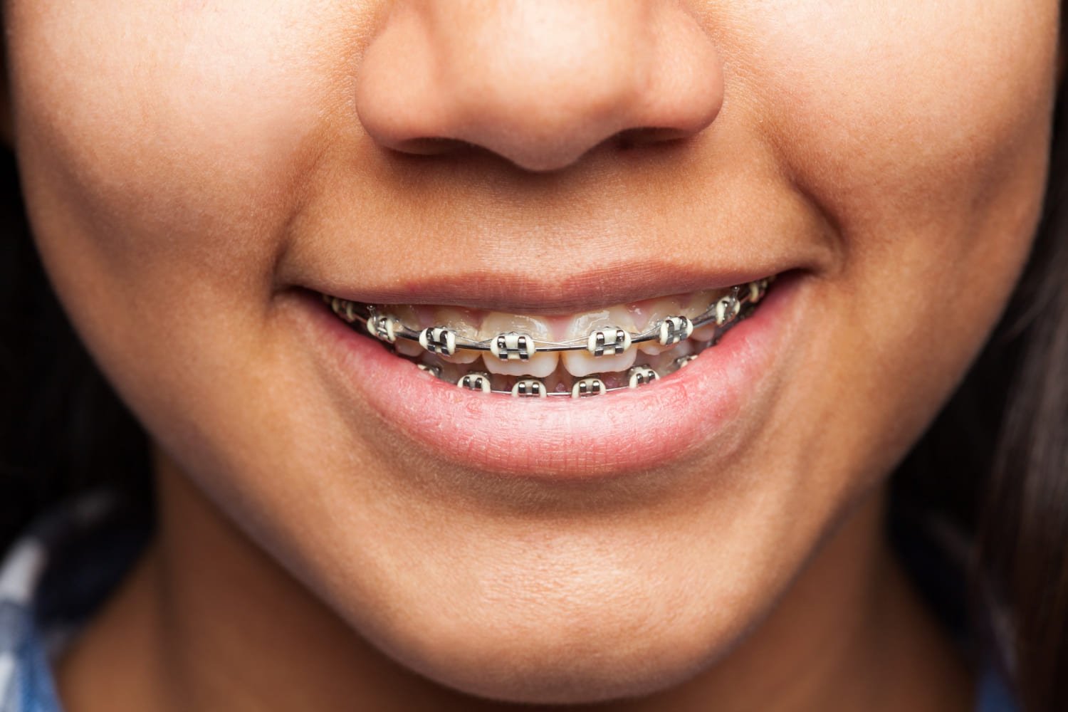 Dental Clinic Ang Mo Kio: Braces vs Invisalign Cost & Options - Asia ...